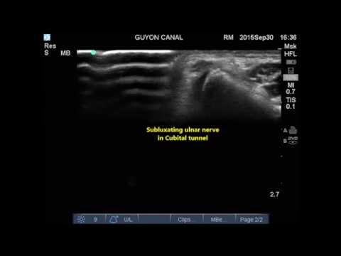 Subluxation of ulnar nerve out of cubital tunnel - YouTube