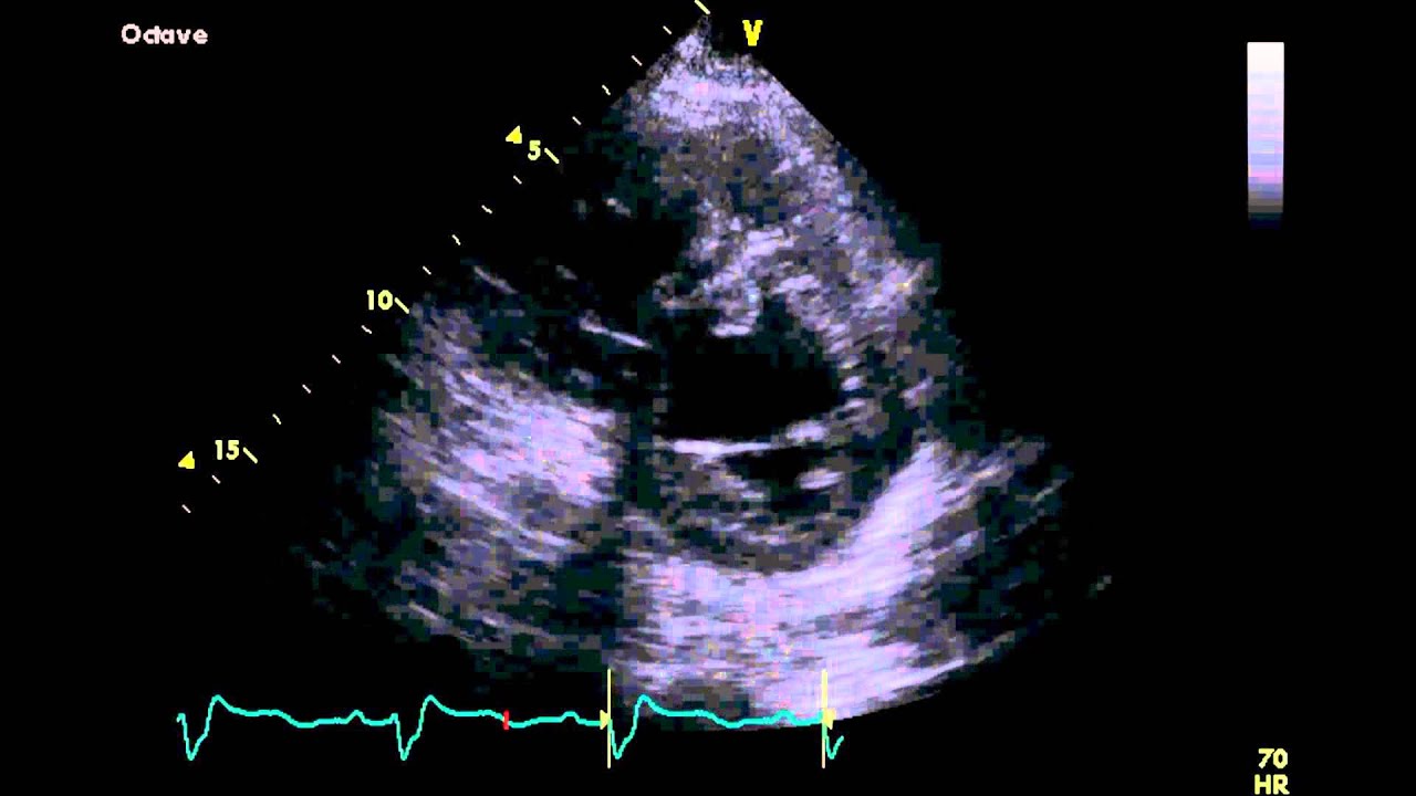Left Atrial and Ventricular Thrombus - Transthoracic Echocardiogram ...