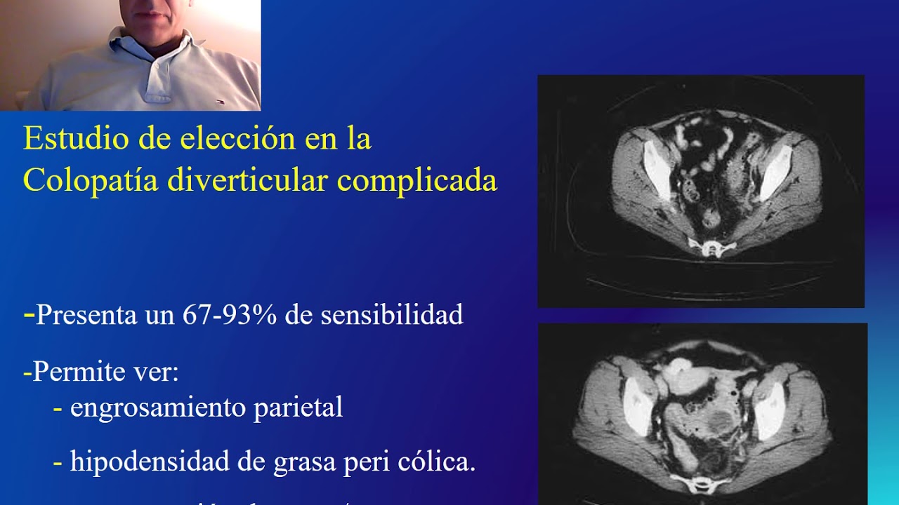 Colopatìa diverticular y sus complicaciones - YouTube