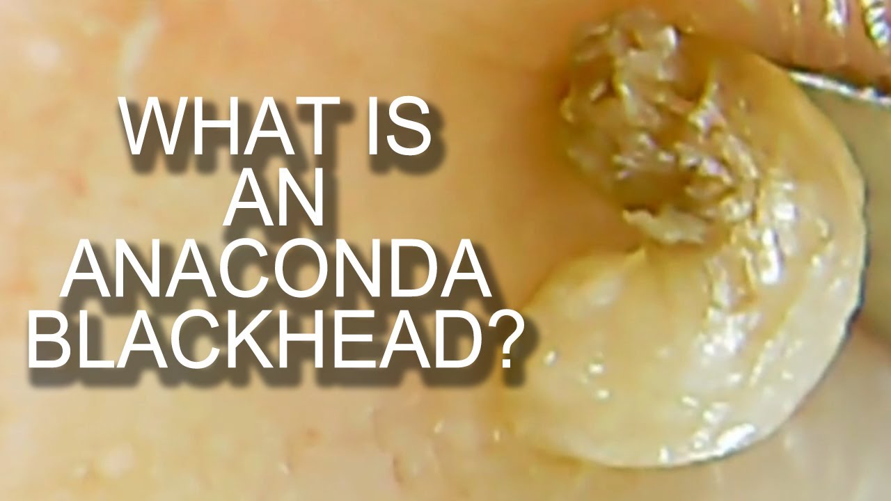 Anaconda Blackhead, Under the Microscope! Long Blackheads - YouTube