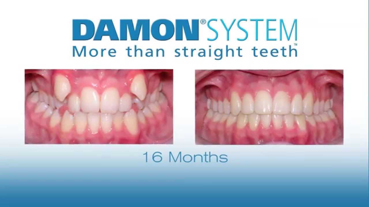 Damon System Informacoes - YouTube