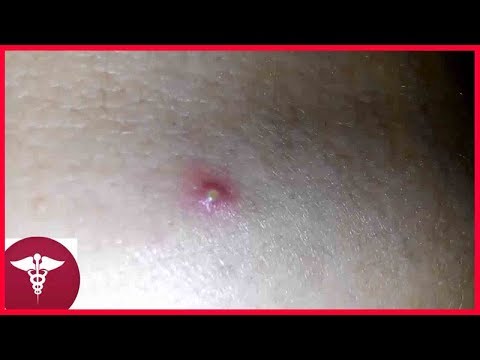 Removal of pimple extraction close up "Pimples and dermatology" - YouTube