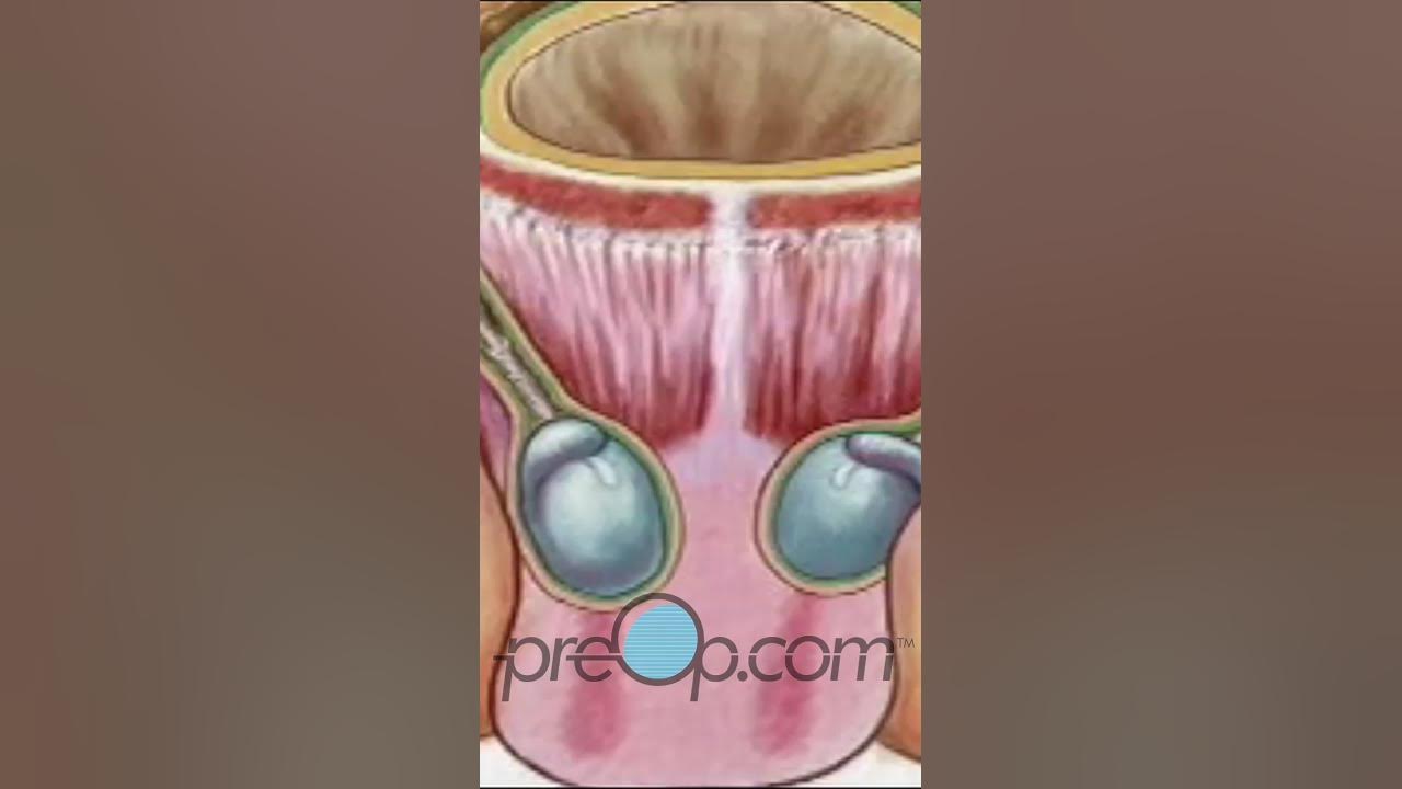 Hernia Repair Inguinal Open Surgery Preop® Patient Education