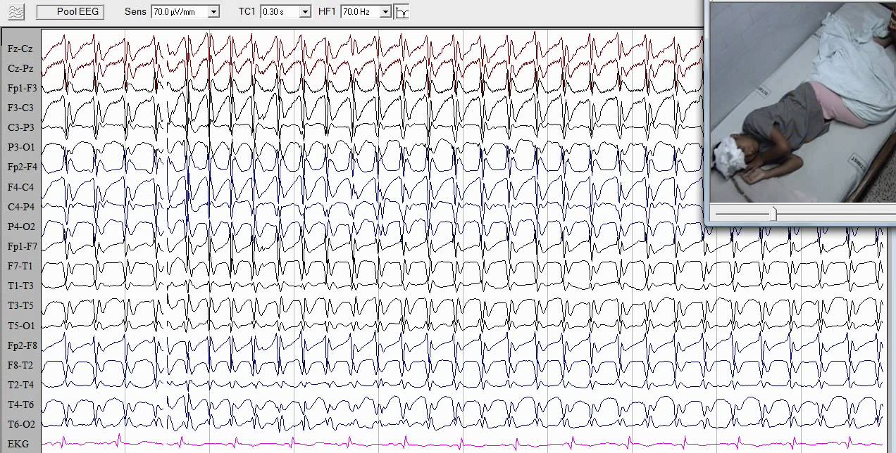 Epilepsy with myoclonic absences (2 of 2) - YouTube