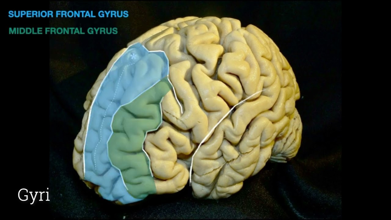 Frontal craniotomy. Right side middle frontal gyrus astrocytoma. - YouTube