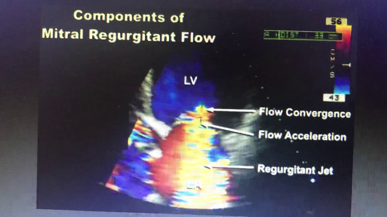 Mitral regurgitation colour jet - YouTube