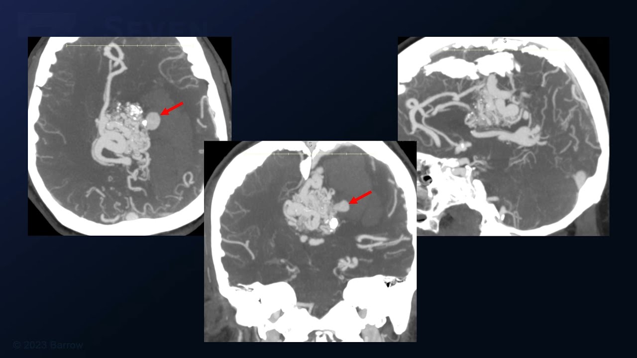 Anterior Interhemispheric Approach for Resection of a Corpus Callosum ...