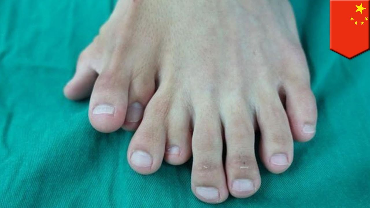 Man with 9 toes on left foot has freeloaders removed - TomoNews - YouTube