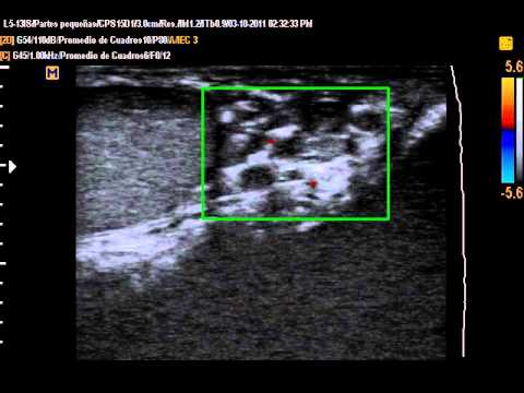 Accuvix XG Doppler Color Varicocele - YouTube