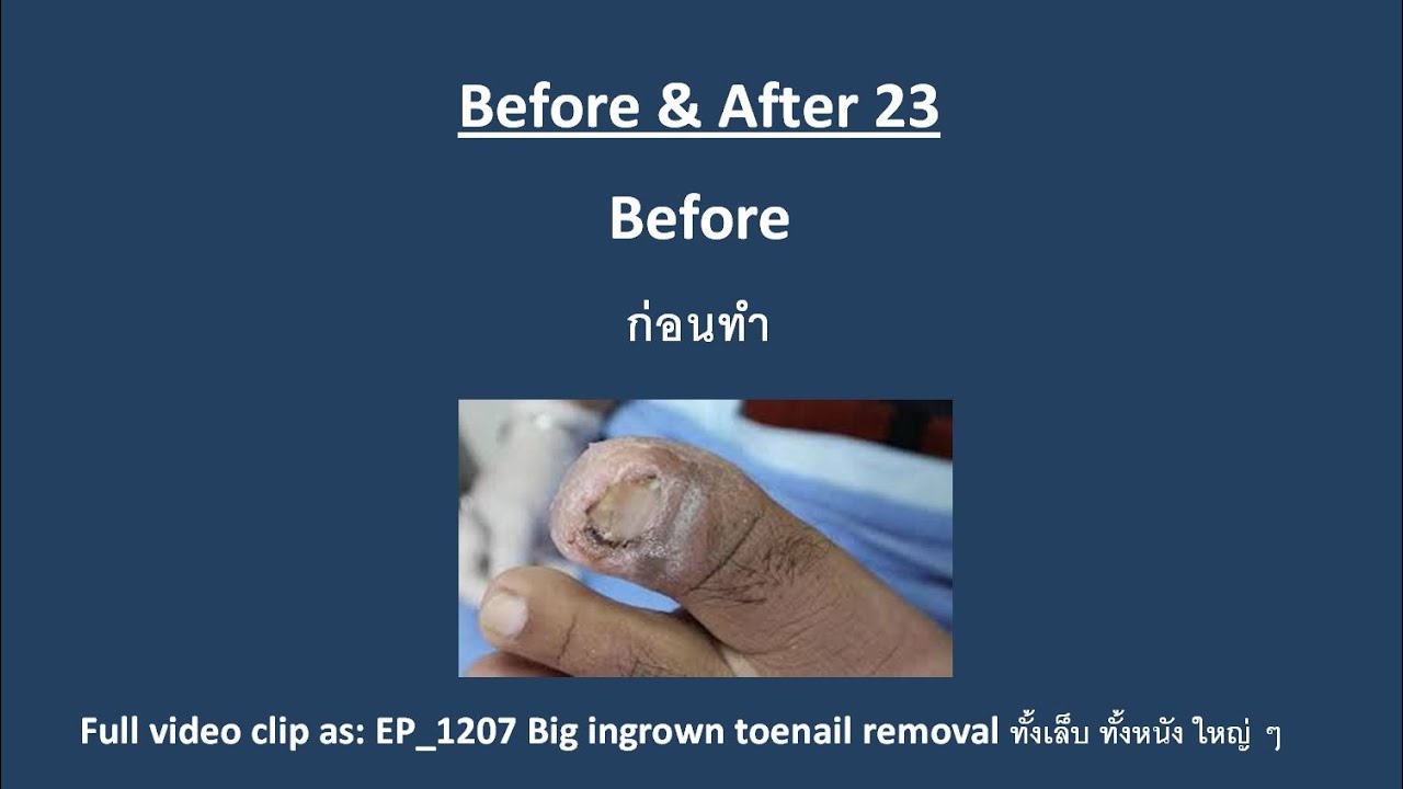 BA_23 Before and After 👣 มาดูแผลเล็บขบหลังจากน้องมาทำกับพี่เอื้อม (This ...