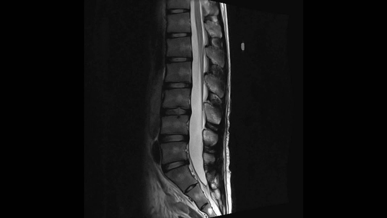 MRI Scan Lower Back Can You Tell Me What s Wrong YouTube MRI Scan Lower Back Can You Tell Me What s Wrong YouTube