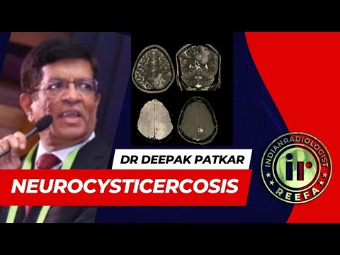 NEUROCYSTICERCOSIS || DR DEEPAK PATKAR || scolex | TB vs neurocysticercosis