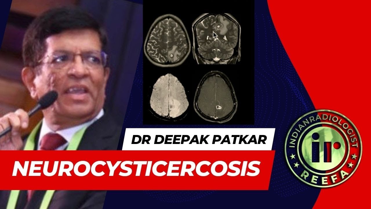 NEUROCYSTICERCOSIS || DR DEEPAK PATKAR || scolex | TB vs ...