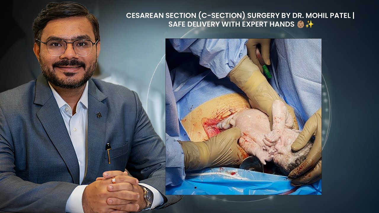 Cesarean Section (C-Section) Surgery by Dr. Mohil Patel | Safe Delivery ...