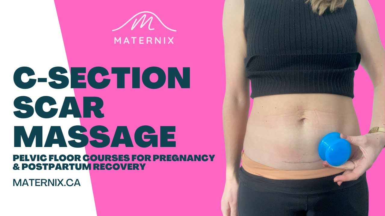 C-Section Scar Massage and stretching How-To - YouTube