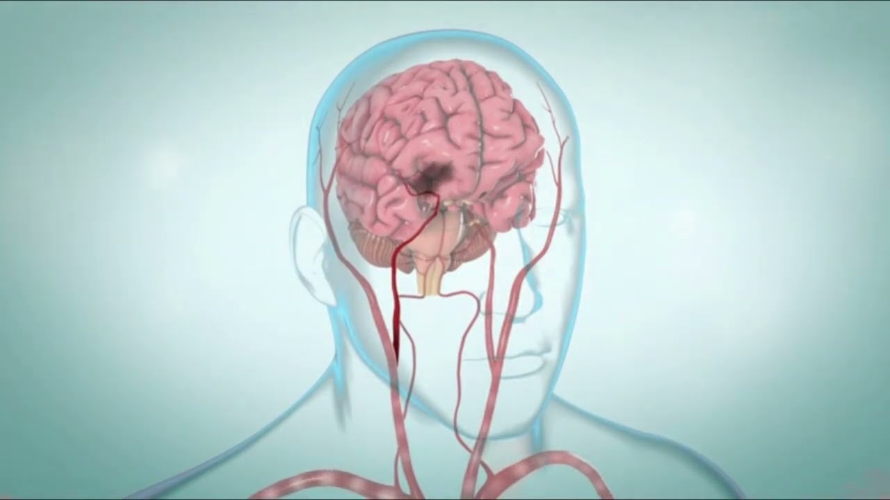Ischemic Stroke: A Comprehensive Guide to Signs, types, and Treatment ...