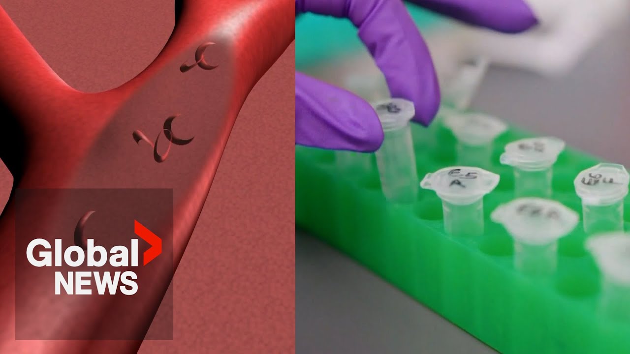 US FDA approves 2 sickle cell gene therapies in medical breakthrough ...