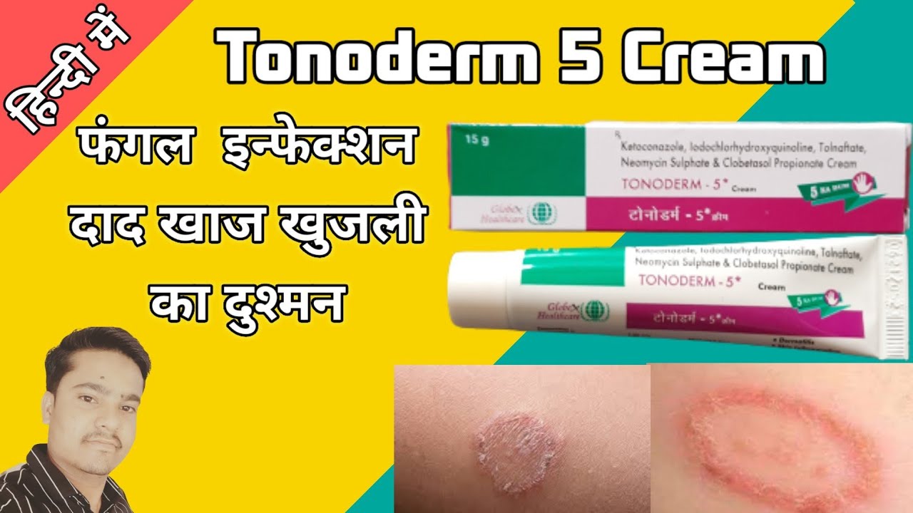 Tonoderm 5 Cream Uses in Hindi || दाद खाज खुजली का दुश्मन || # ...