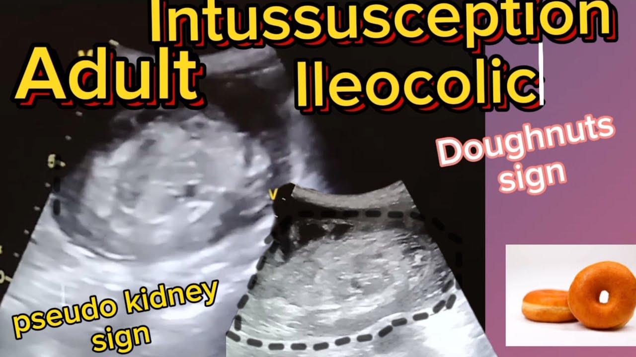 " Intussusception: Exploring Diagnosis through Ultrasound Imaging ...