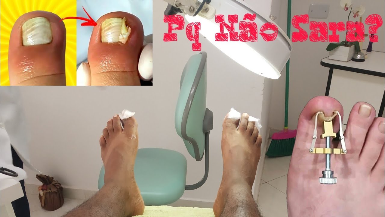 Unha Encravada! OQUE FAZER DEPOIS DA CANTOPLASTIA - YouTube