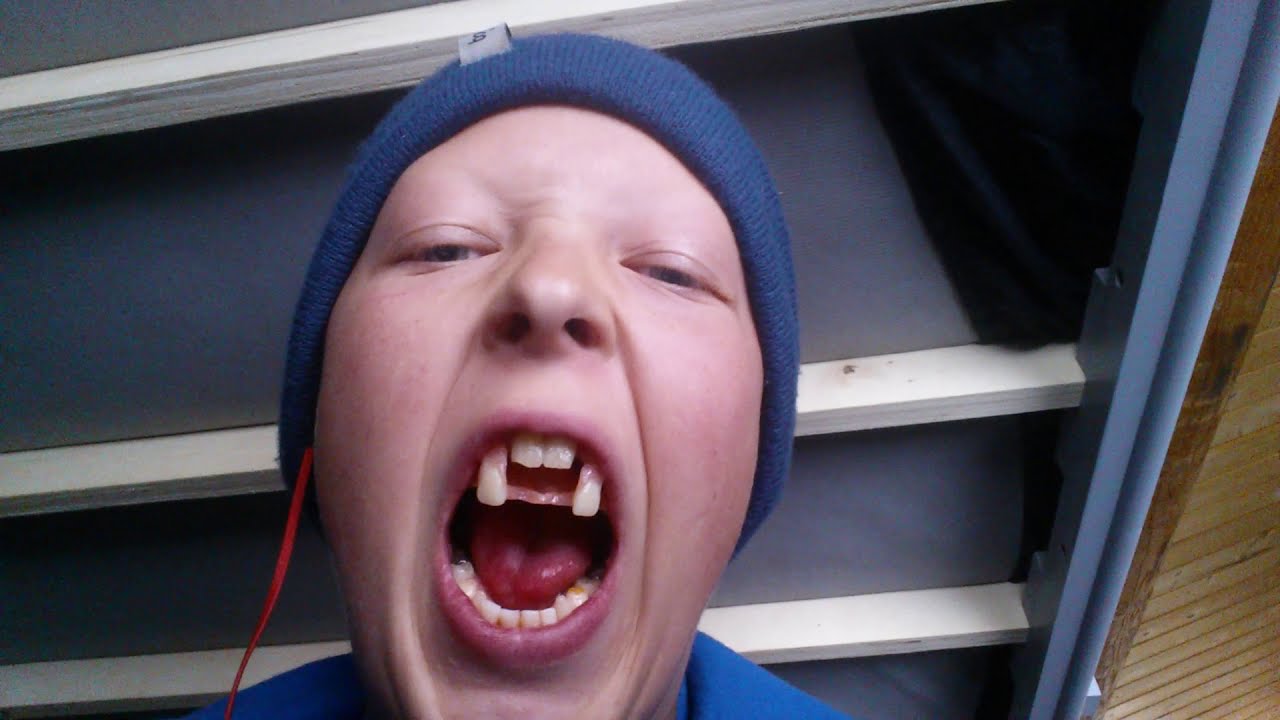 your boy has dentures. - YouTube