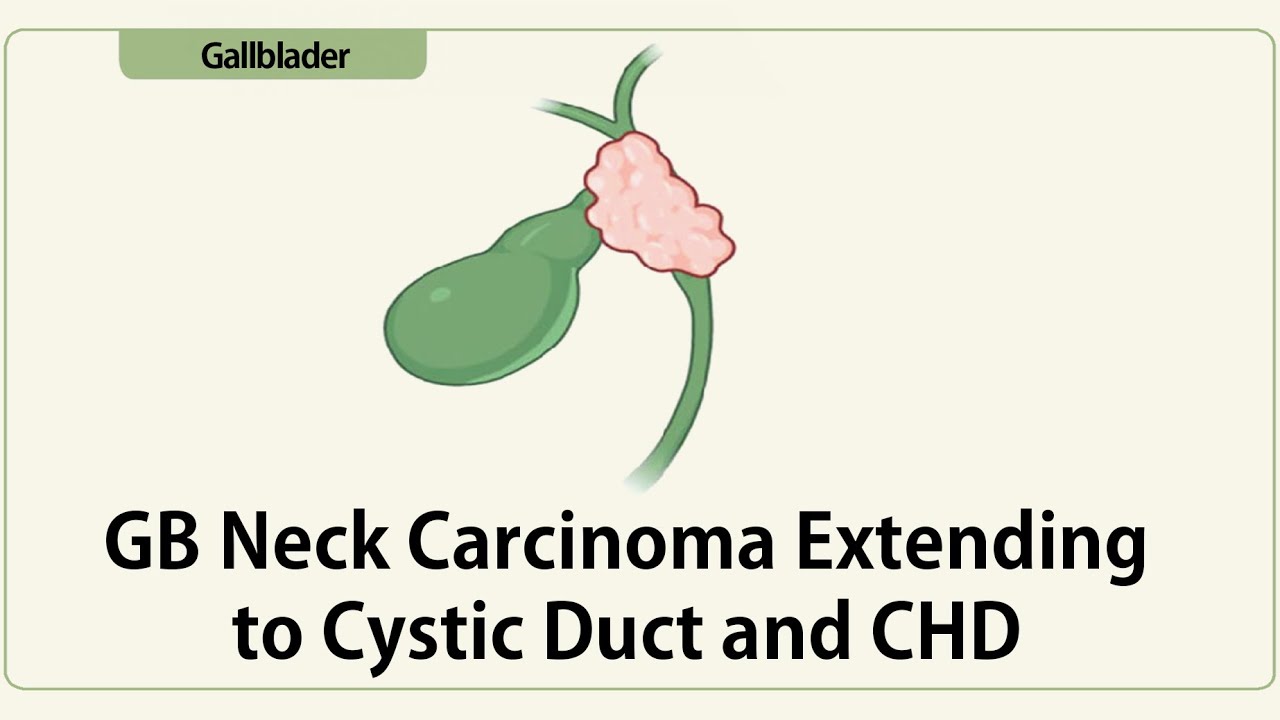 GB Neck Carcinoma Extending to Cystic Duct and CHD - YouTube