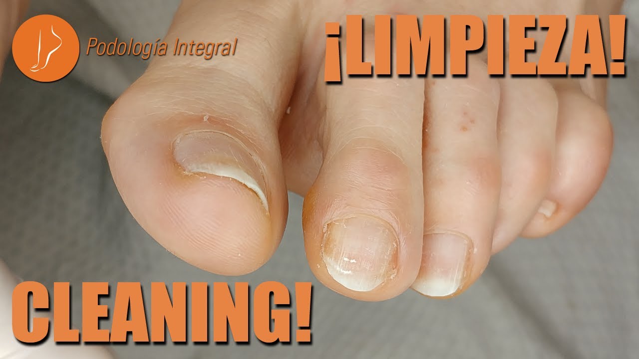 Cleaning! [Podología Integral] Integral Podology - YouTube