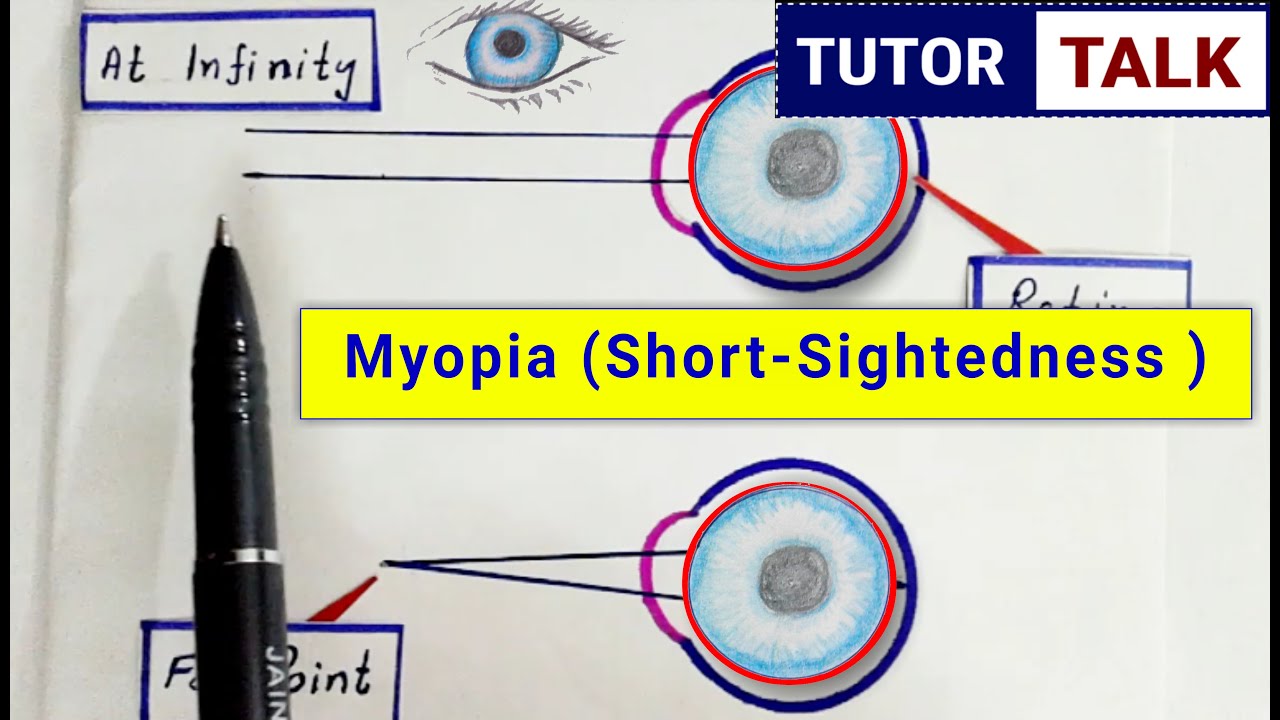 What is Myopia | Short Sightedness | Defects of eye class 10 | Causes ...