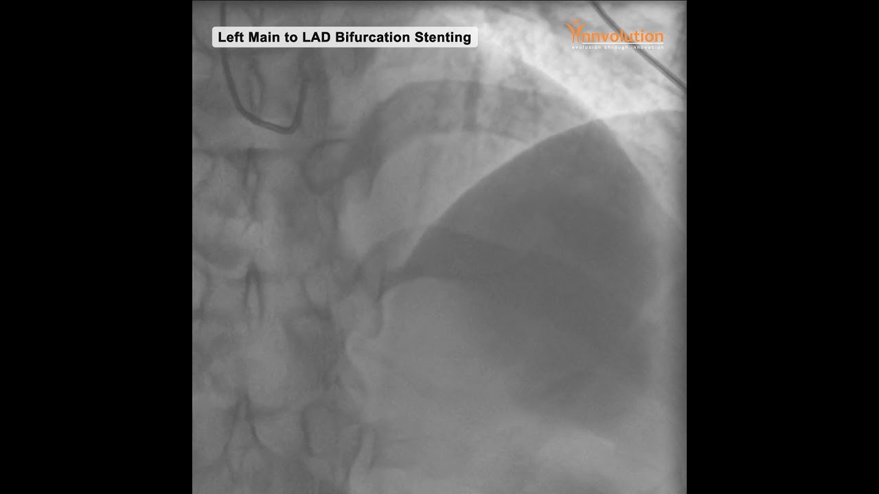 Left Main to LAD Bifurcation Stenting on Innvolution Cath Lab - YouTube