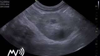 Ecografía de esofago contrastada - Cuerpo extraño Lineal | Doovi