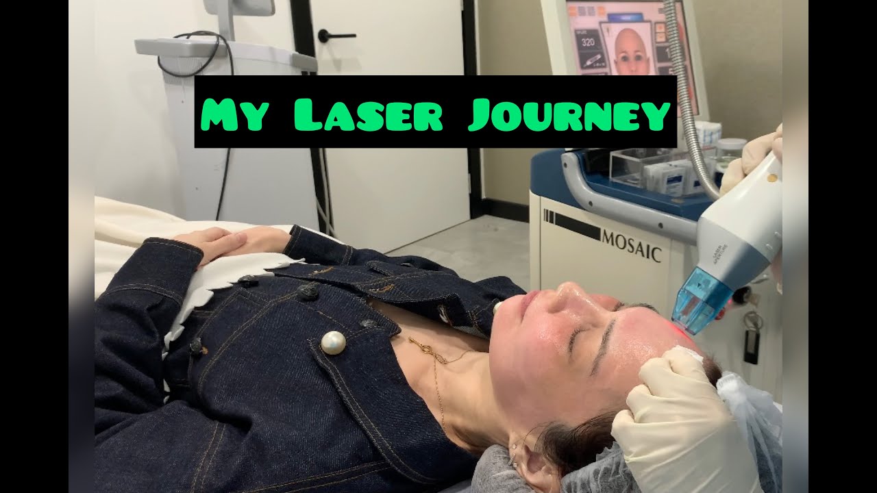 LASER SKIN REJUVENATION |Mosaic Fractional Laser Treatment on a Budget ...