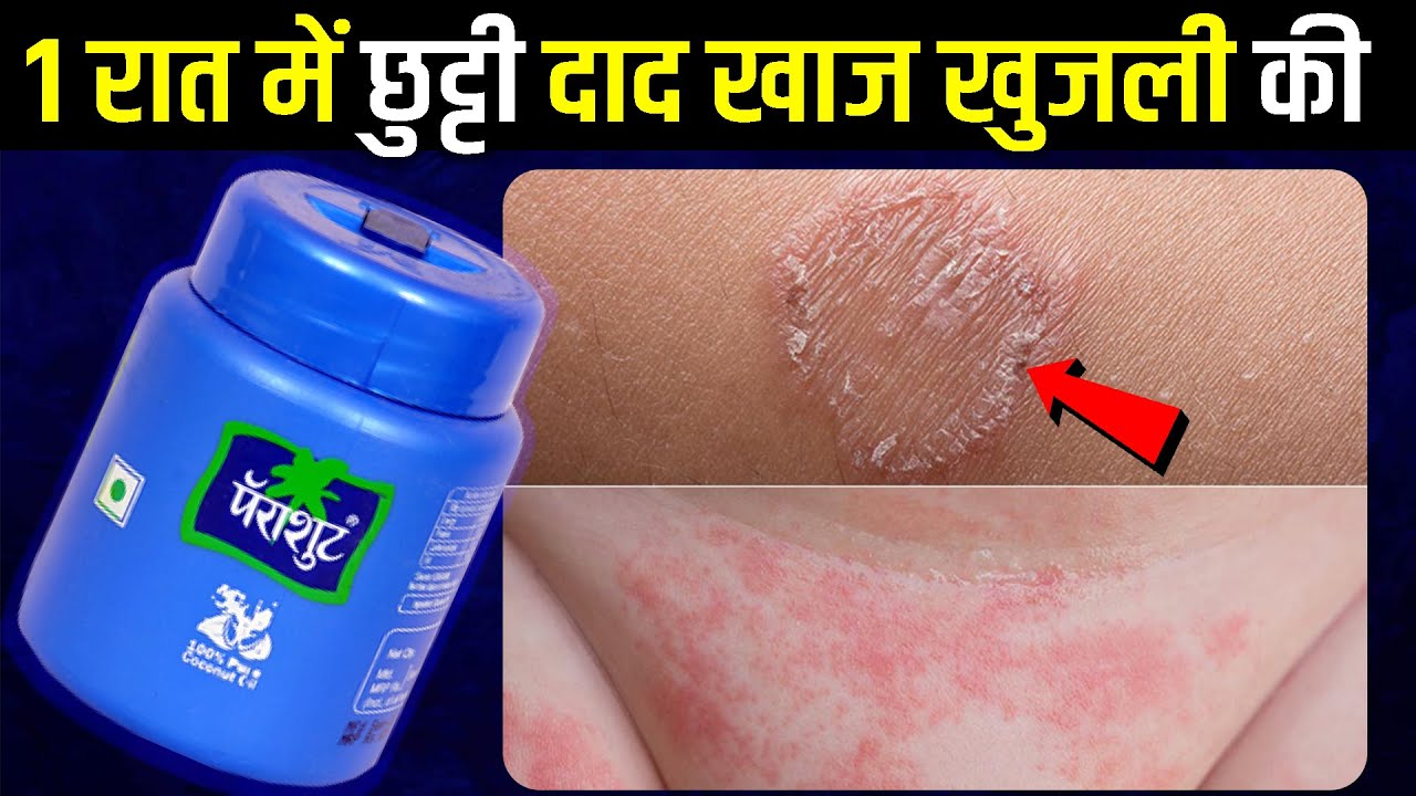 दाद खाज खुजली की 15 मिनट में छुट्टी कर देगा -Fungal Infection Treatment ...
