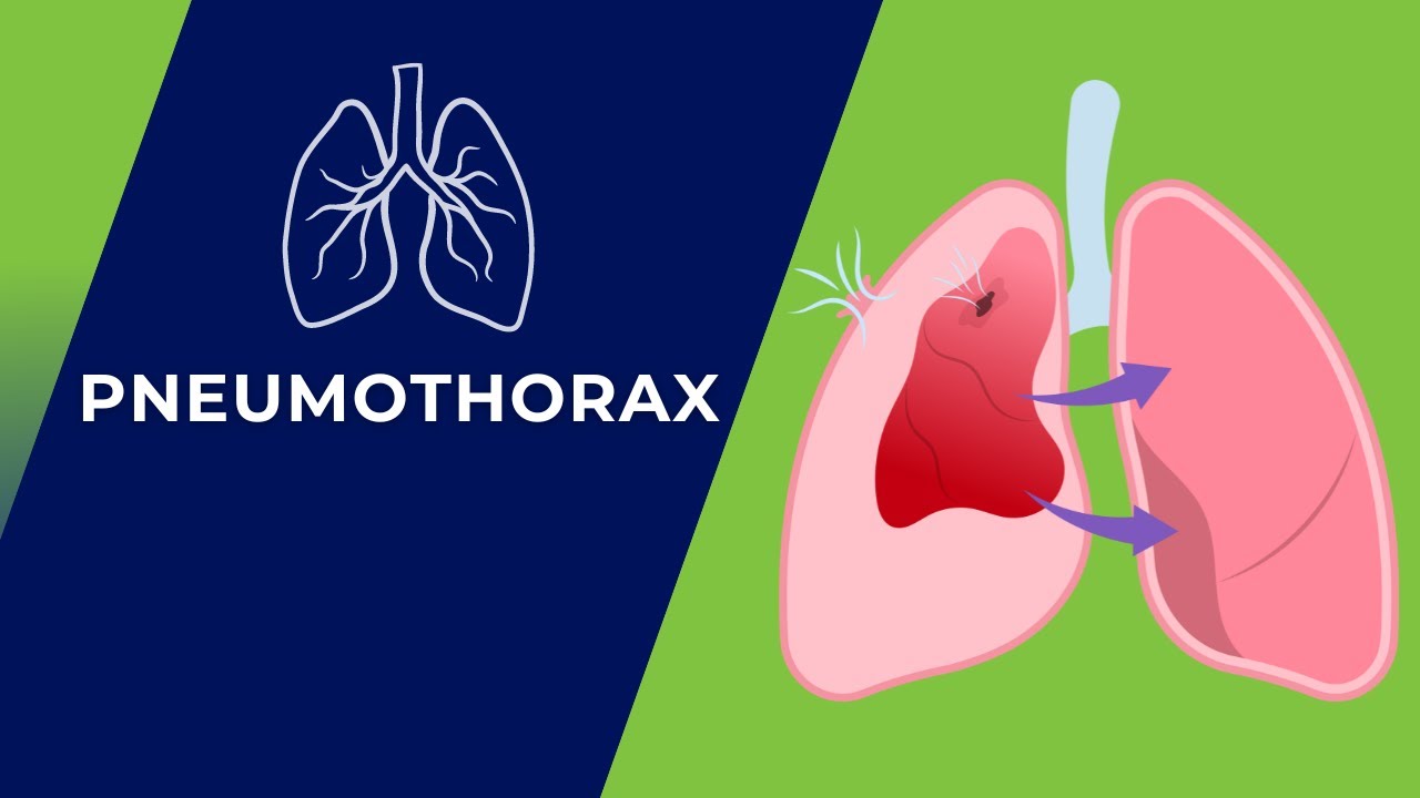 Pneumothorax Youtube