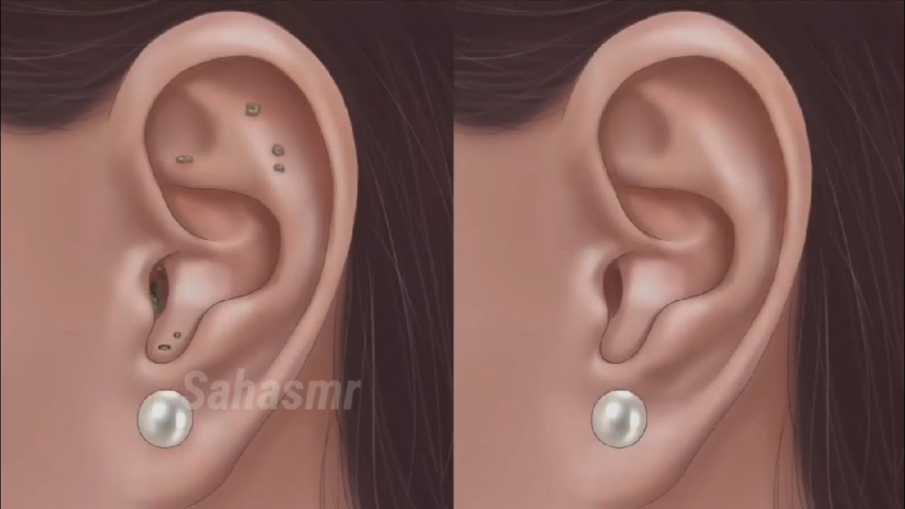 Asmr | ear pimples blackhead care| water device removes earwax |ear ...