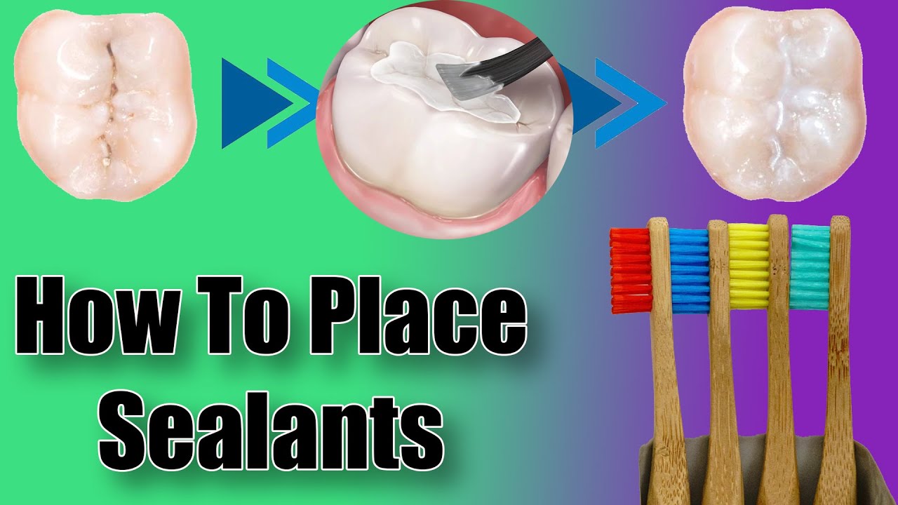 Dental Sealants - Prevent Cavities - Protective Tooth Paint - YouTube