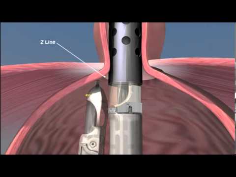 TIF animated procedure video - YouTube