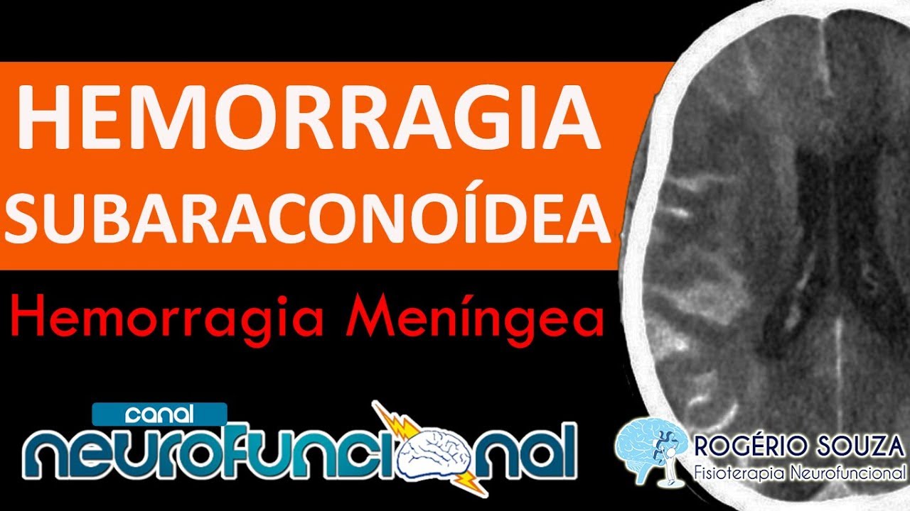 HEMORRAGIA SUBARACNOÍDEA (HSA) - Aula Completa - TCE #4 - YouTube