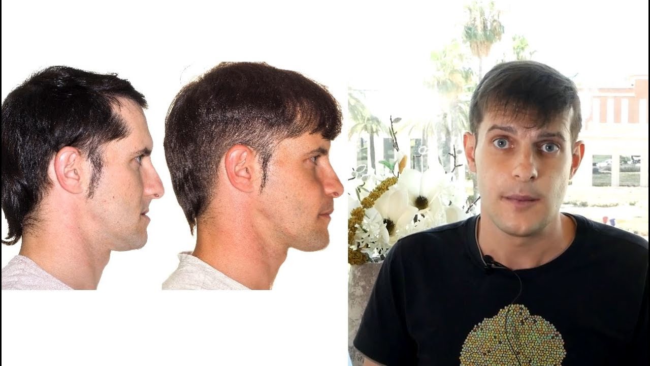 Jaw surgery Case #130: David-Class III, maxillary hypoplasia - YouTube