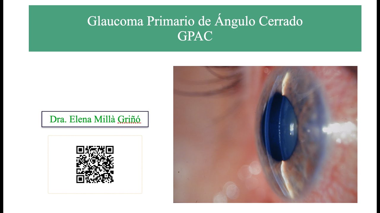Glaucoma Primario De Ángulo Cerrado Glaucoma Agudo Youtube