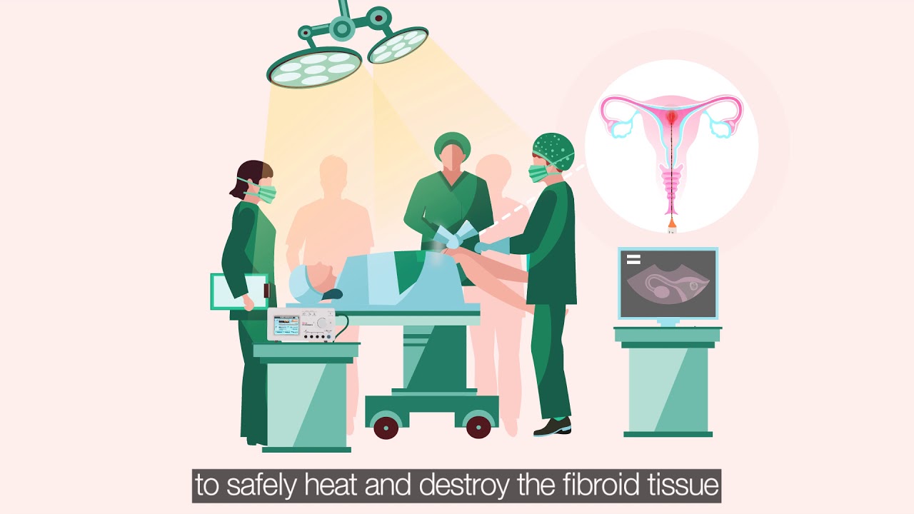 STARmed Uterine Fibroid RFA - YouTube