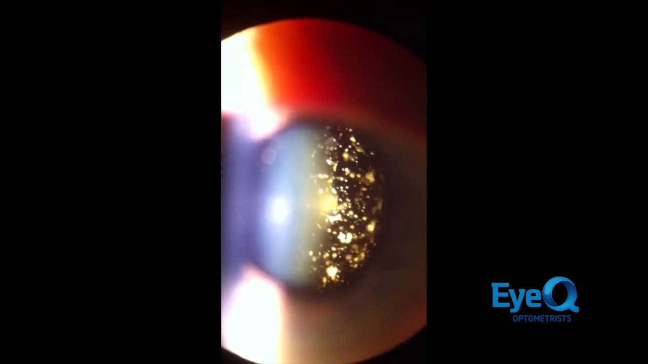 Amazing gold floaters in the eye! (Asteroid Hyalosis) - YouTube