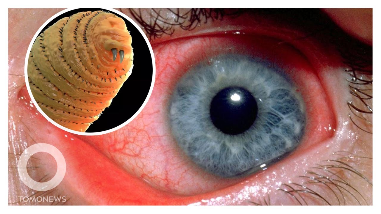 Cacing di Mata! Puluhan Larva Lalat Ada di Dalam Mata Pria Ini - YouTube
