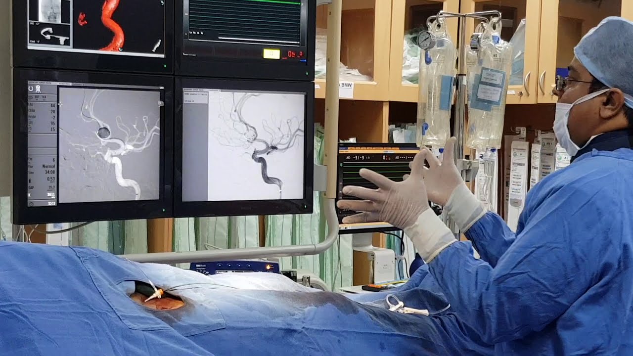 Balloon assisted coiling of cerebral aneurysm - YouTube