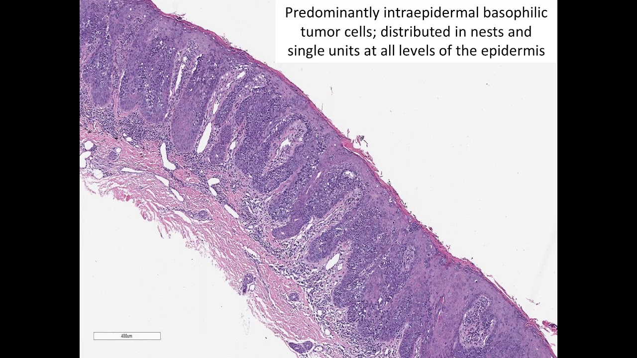 Dr Phyu P Aung, MD, PhD Update on CAP and AJCC TNM staging parameters ...