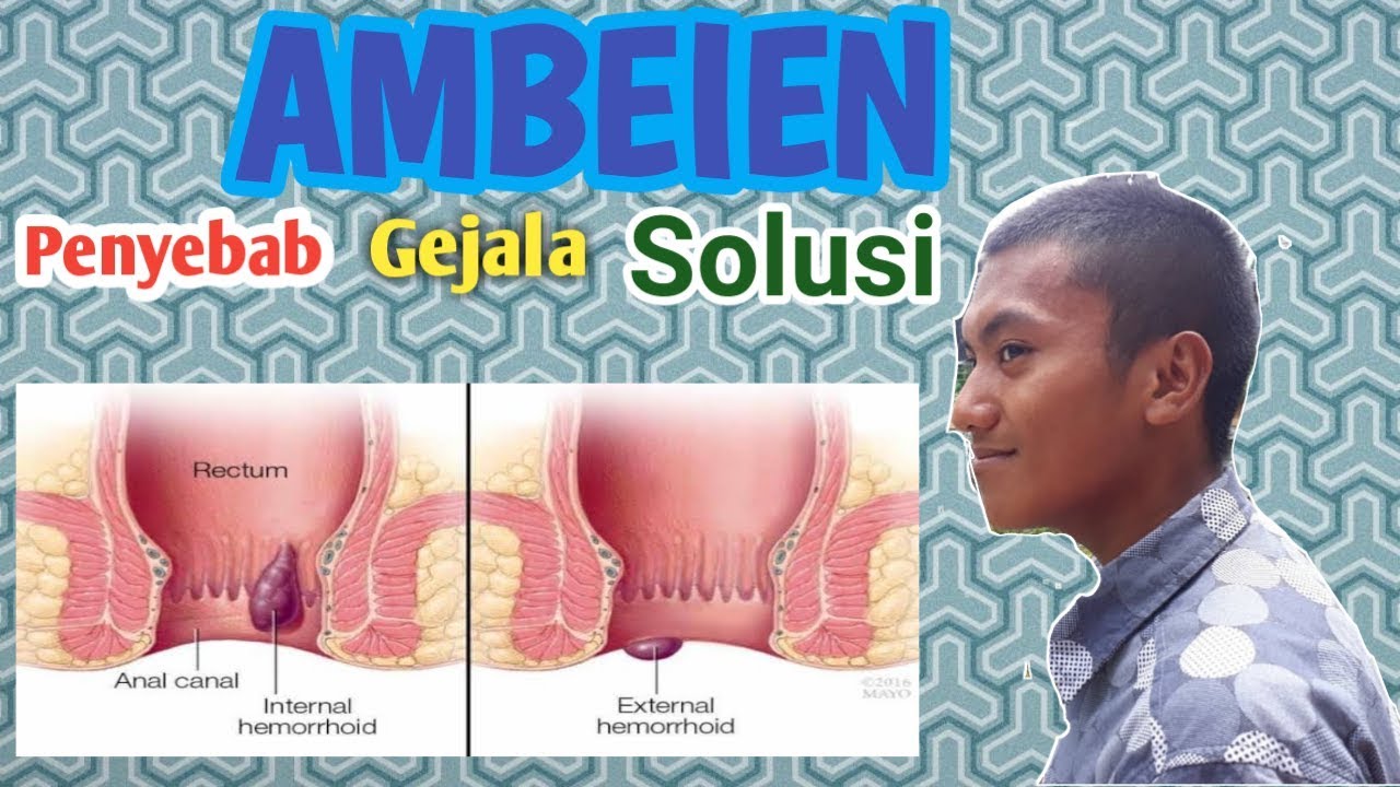 Apa itu Ambeien dan Cara Mengatasinya - YouTube