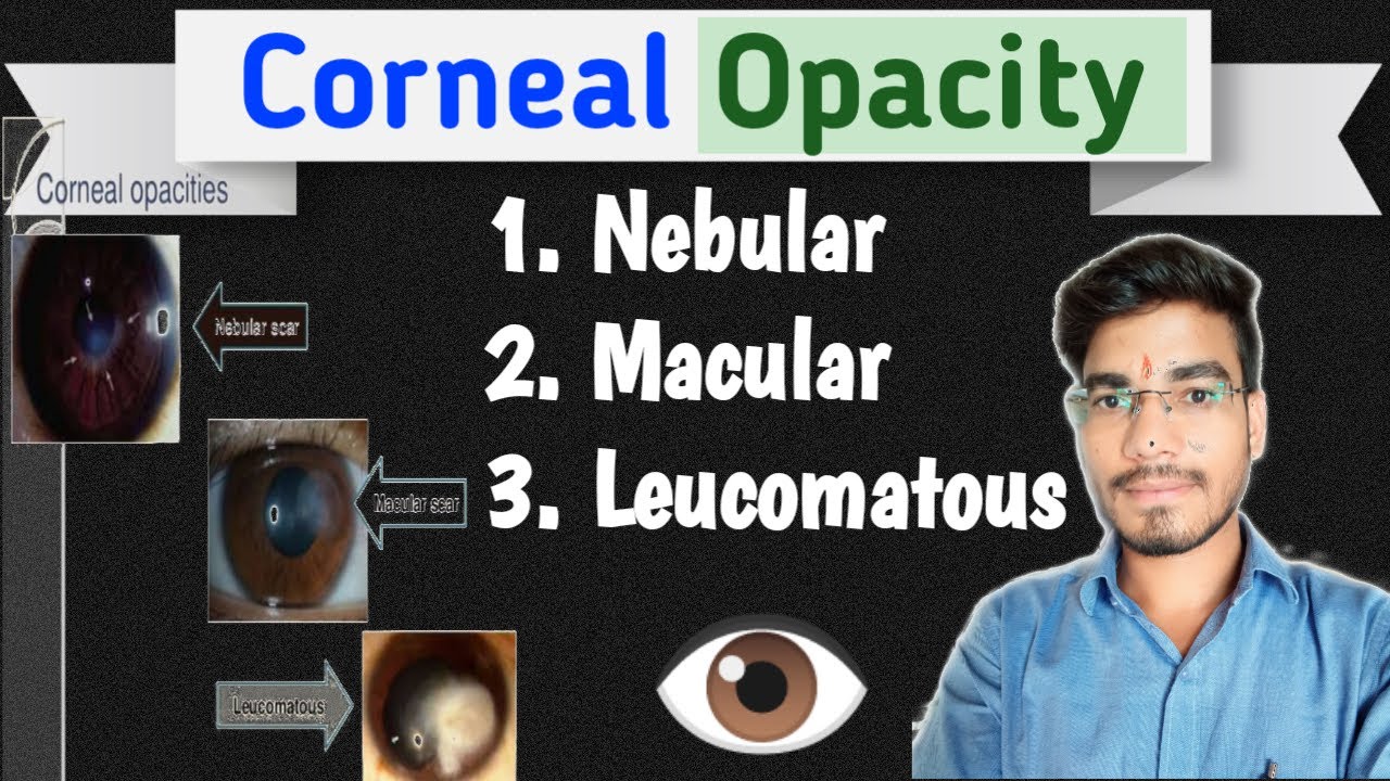 Corneal Opacity || The Cornea || M.K.Sharma [Ophthalmic Education ...