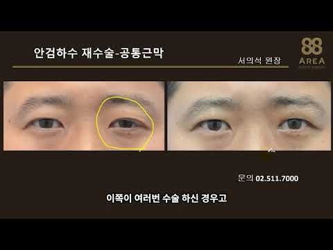 공통근막(CFS) 수술 후 환자가 말하는 눈 관리 방법 - YouTube