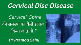 Cervical Spodylosis- Cervical Myelopathy and Radiculopa... | Doovi