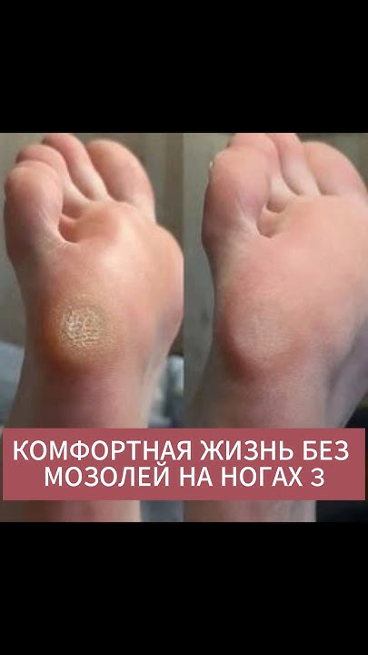 Избавление от мозолей на ногах без страха - YouTube