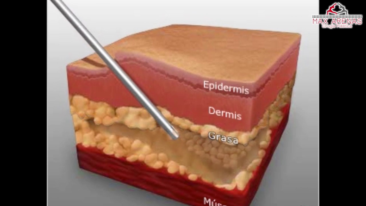 Liposuccion - YouTube